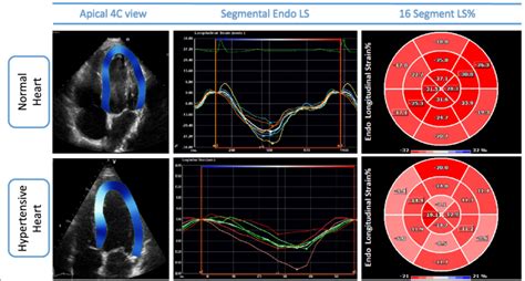 Segmental Speckle Tracking Longitudinal Strain Analysis Segmental Download Scientific Diagram