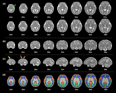 Spatiotemporal Structural Atlas Of Fetal Brains Based On Chinese