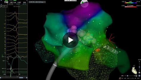 Our Case Of The Day Bipolar Pvc Ablation With An Active Ablation Catheter In The Septal Rvot