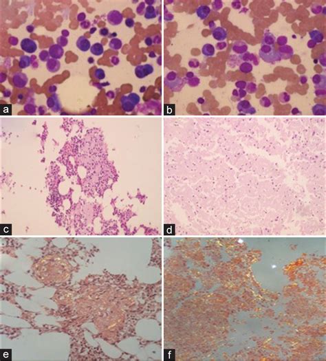 Hidden Amyloidosis In Liver And Bone Marrow Journal Of Hematology And