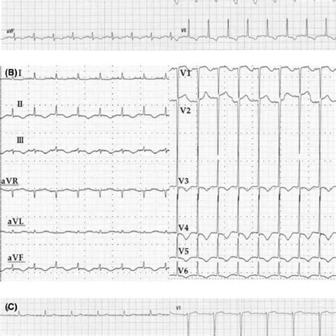 A ECG On Admission Inverted T Waves Were Observed In The II III Download Scientific