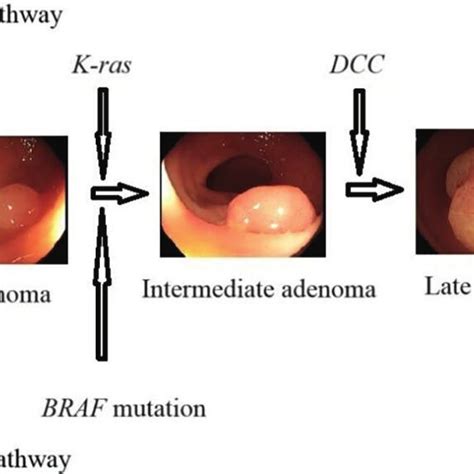 Adenoma To Carcinoma Sequence In Development Of Colorectal Cancer