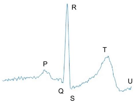 Fiducial Points Highlighted Plotted Out Over One Ecg Signal From Cybhi Download Scientific