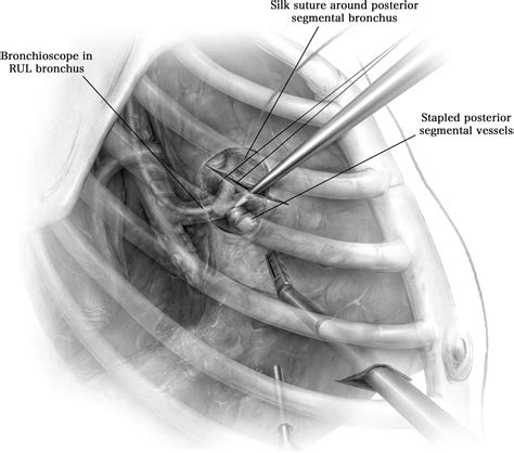 Minimally Invasive Segmentectomy Operative Techniques In Thoracic And