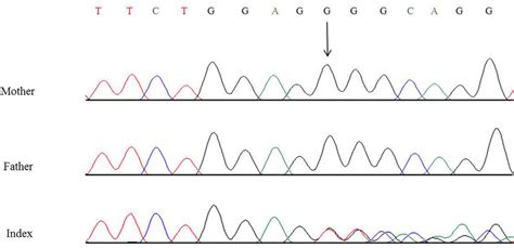Partial Nucleotide Sequence Of Exon 3 Of Pbx1 Of The Patient And His Download Scientific