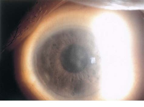 Diffuse Lamellar Keratitis