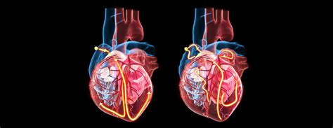 Cardioversion Ucsf Health Cardioversion Ucsf Health