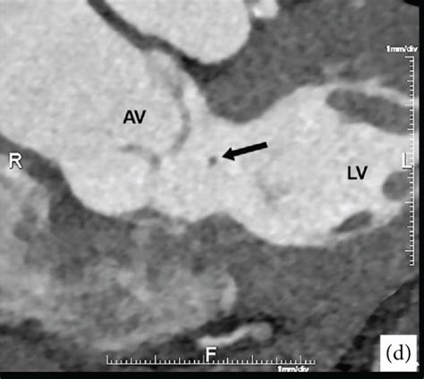 A Tte Imaging Of A Subaortic Membrane And Mass Arrow On The Download Scientific Diagram
