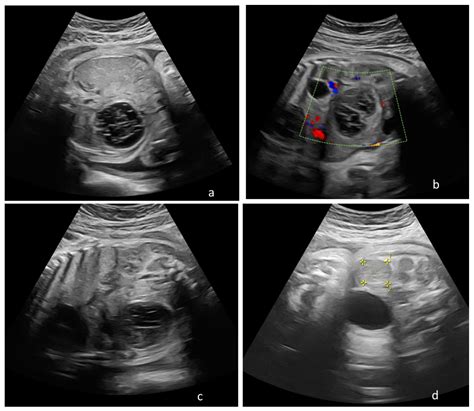 Fetal Ovarian Cysts Prenatal Diagnosis Using Ultrasound And Mri