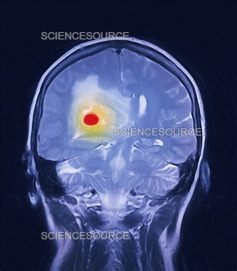 Brain Tumor MRI Scan Stock Image Science Source Images
