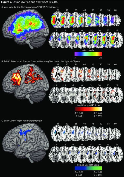 lesion overlap and support vector regression lesion symptom mapping