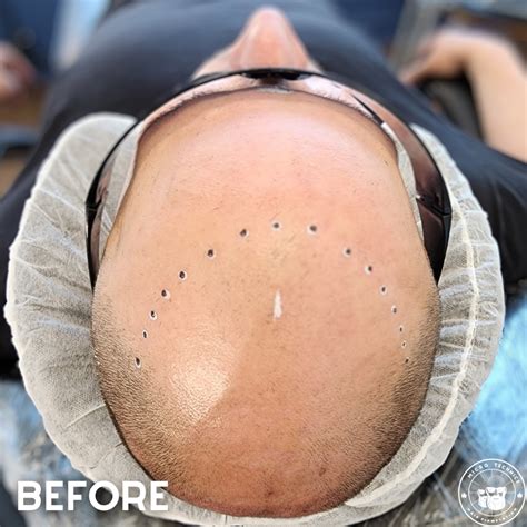 Scalp Micropigmentation Healing Timeline What To Expect After Each
