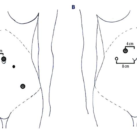 Schematic Diagram Showing The Port Placement For Robotic Assisted And