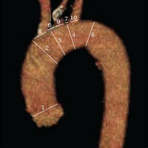 Multidetector Computed Tomography Angiography Showed The Parameters Download Scientific Diagram