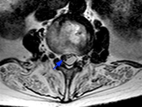 Dural Ectasia Radsource