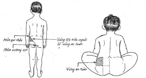 Why Buttock Injections Vinmec