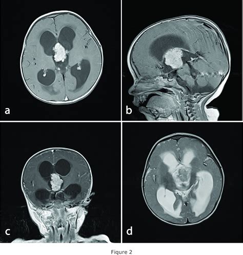 Figure 1 From An Extremely Rare Case Of Choroid Plexus Carcinoma In Third Ventricle Of An Infant