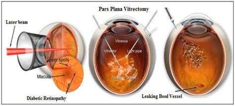 Treatment Options Laser Surgery Vitrectomy Surgery And Medication
