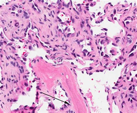 Angiosarcoma Histology Pathology Outlines Angiosarcoma