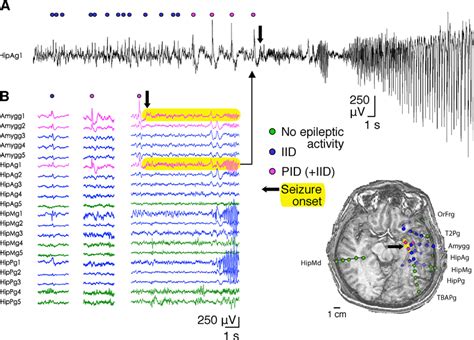 In Vivo Stereoelectroencephalographic Seeg Recording Of Pre Ictal Download Scientific Diagram