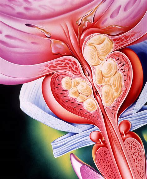Artwork Of A Benign Prostatic Hyperplasia Poster By Science Photo
