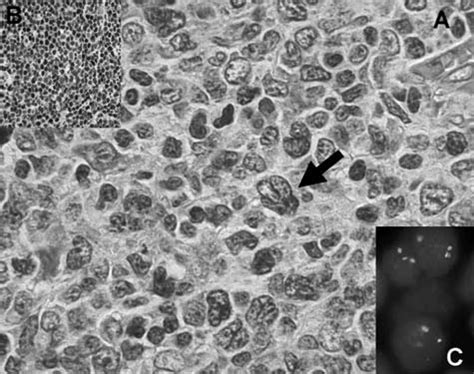 A The Second Biopsy Shows A Diffuse Infiltrate Consisting Of Download Scientific Diagram