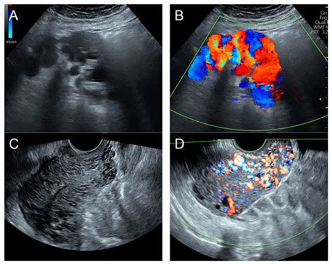 Sonographic Features Of Uterine Arteriovenous Malformation A Case Series