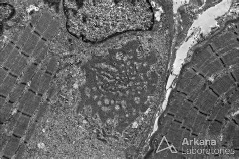 Neuromuscular Junction In 60 Year Old Patient Arkana Laboratories