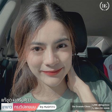 🛑 ยังเปิดรับอยู่น้า 👩‍⚕️ คุณหมอกวาง👩‍⚕️ เปิดรับเคสเพิ่ม เสริมคาง โปรรีวิว 9 999 … สวยครบจบ