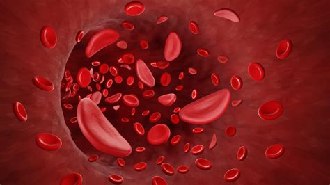 Hypoxia Fetal Hemoglobin Link May Lead To Novel Sickle Cell Therapies