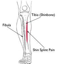 Shin Splints OrthoInfo AAOS