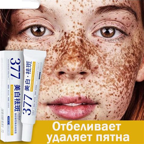 Крем отбеливающий для лица против пигментации и пигментных пятен от веснушек комплексного