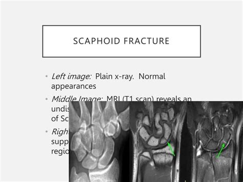 X Ray Diagnostics Of Fractures And Dislocations Pptx