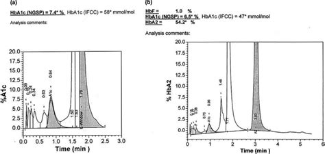 chromatograms from variant ii hplc a determination of hba1c v ii