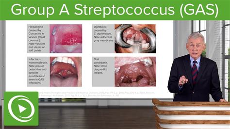 Group A Streptococcus Gas Infectious Diseases Lecturio Youtube
