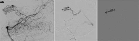 Curative Embolization Of Cerebral Avms Glue Is Still Relevant Case