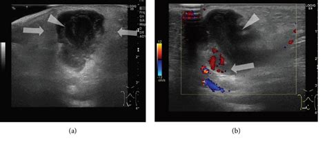 Figure 4 From Point Of Care Ultrasound For Mimicker Lesions Of Incarcerated Inguinal Hernia