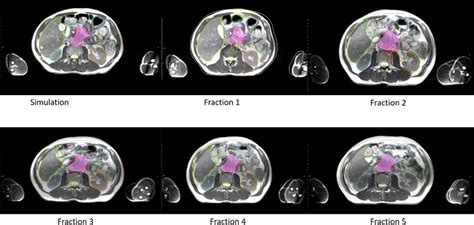 An Example Of Clinical Mri Linac Images Utilized For Inter Fractional Download Scientific