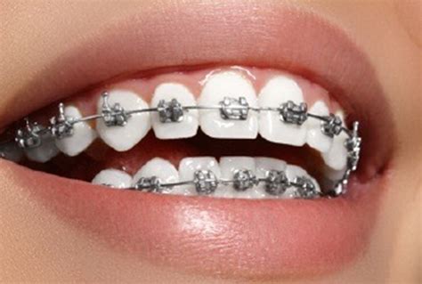 Three Types Of Braces