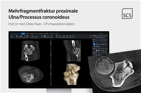 Perspektive Scs „fallvorstellung Mehrfragmentfraktur Proximale Ulnaprocessus Coronoideus Scs