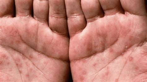 Std Rash Which Stds Cause Rashes