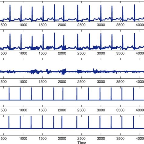 The Diagnosis Application Of Compressed Ecg Data A Original Ecg Download Scientific Diagram