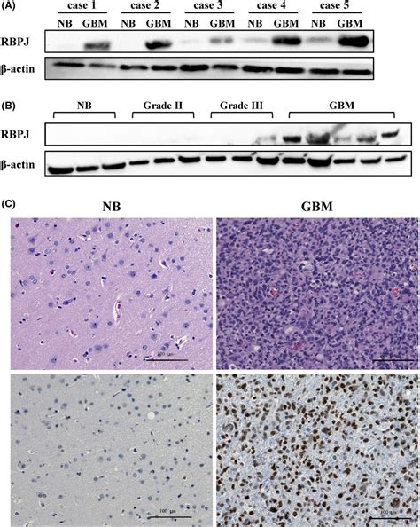 Rbpj Expression In Surgical Glioblastoma Gbm Specimens A Rbpj