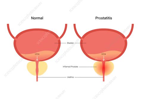 Prostatitis Illustration Stock Image F036 3811 Science Photo Library