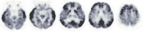 Brain Fluorodeoxyglucose Positron Emission Tomography Images Download Scientific Diagram