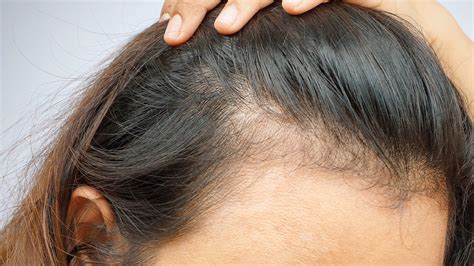 Why Treatments Are Important For Alopecia Areata