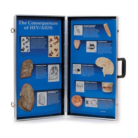 Unsafe Sex Disease Consequences Of Hivaids Model Buyamag Inc