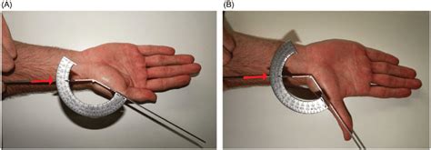 Radius Metacarpal Angle Was Measured With The Subjects Hand In A