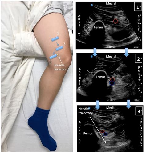 How I Do It Infiltration Between Popliteal Artery And Capsule Of Knee Ipack Eroppa