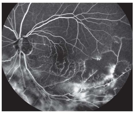 Retinal Neovascularization